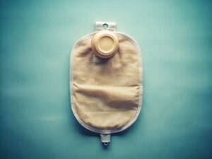 First Days After Stoma Surgery: Complete Care Guide